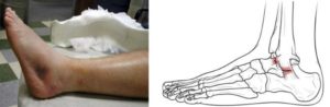 » Grade 2 Ankle Sprain